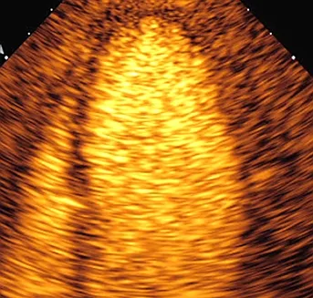 Contrast Echocardiography: Tips & Tricks to optimize your Stress-Echo ...